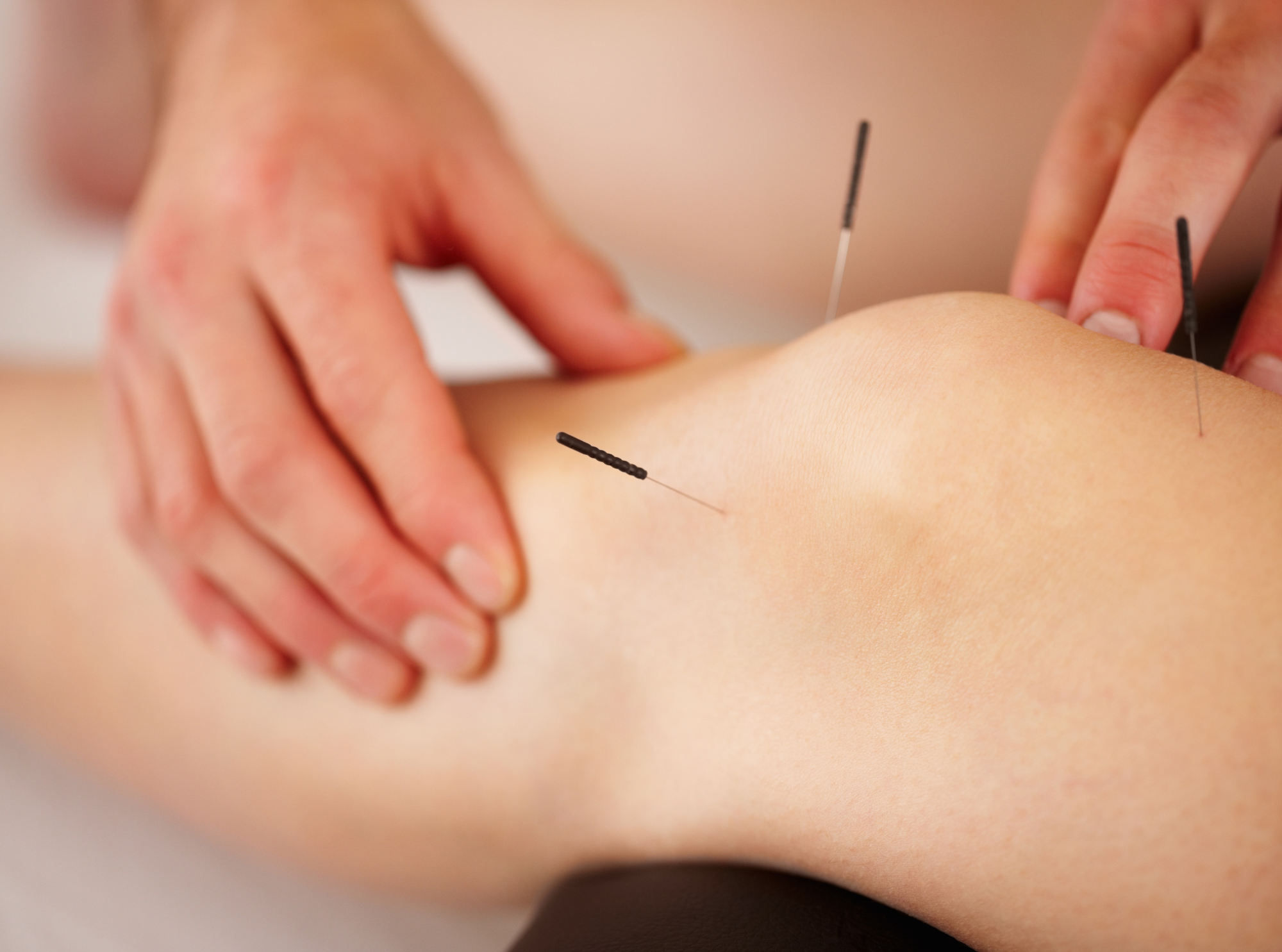 5 Best TCM Pain Management Treatments: How Tuina, Cupping, Acupuncture ...